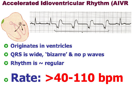 Ventricular rhythms